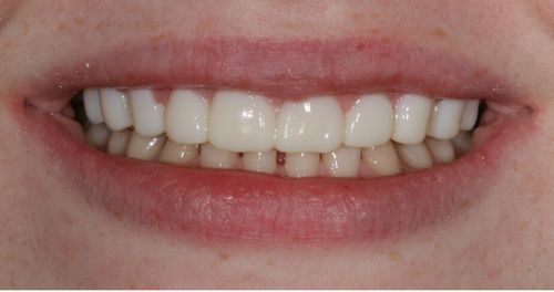 Bespoke Smiles Gallery